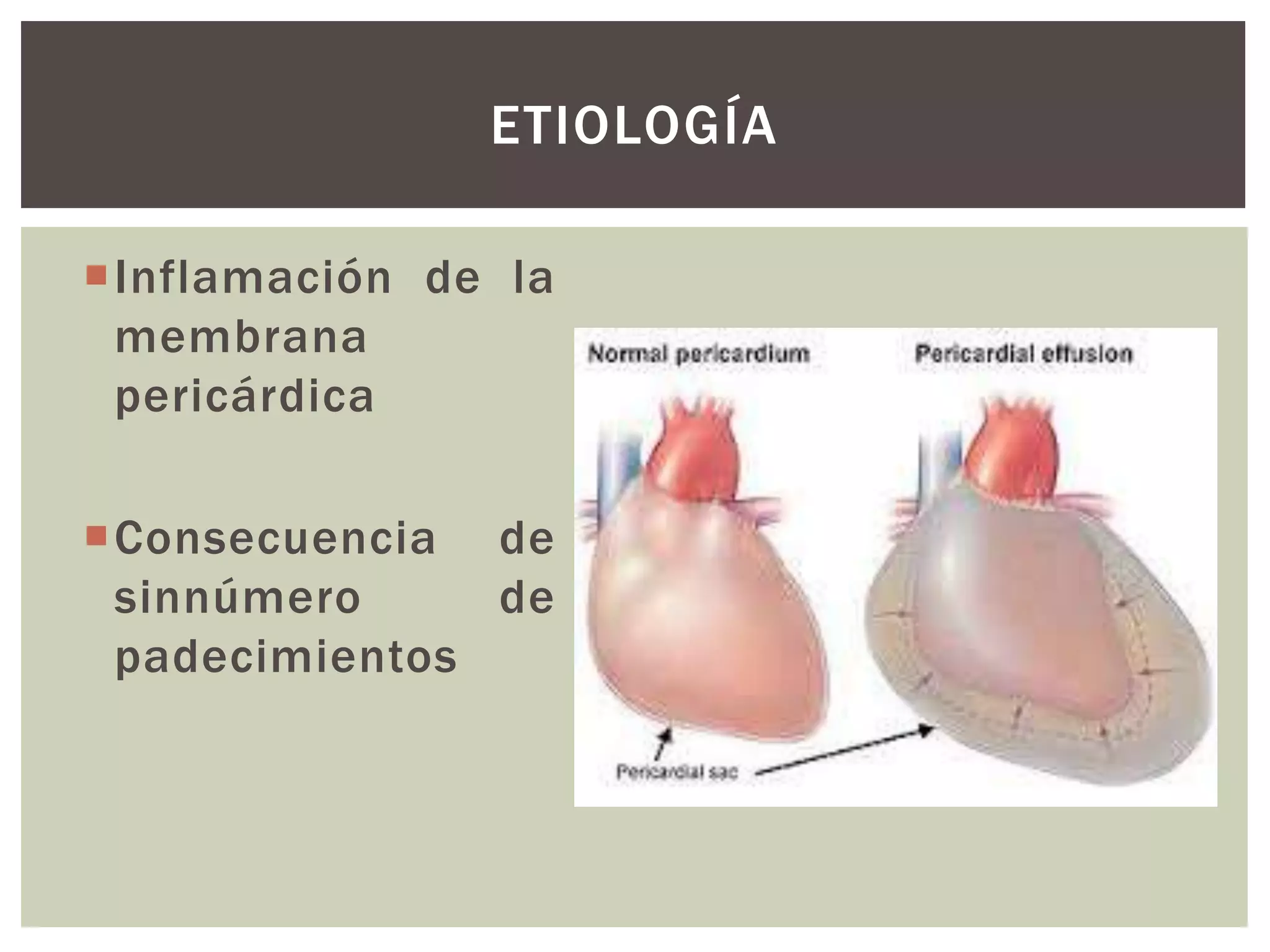 Pericarditis | PPT