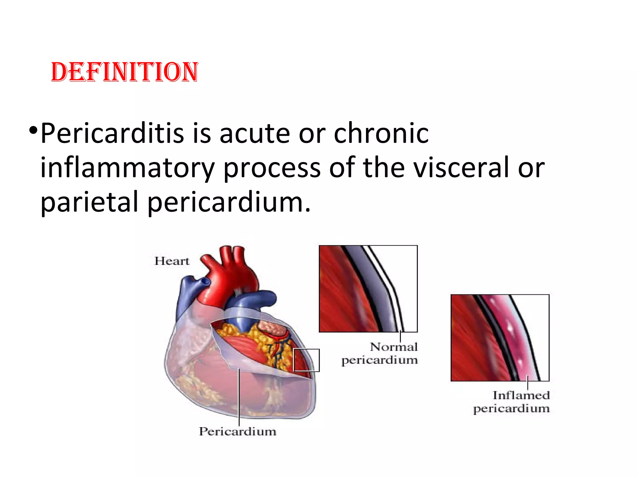 Pericarditis | PPT