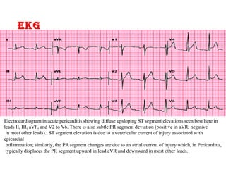 Pericarditis | PPT