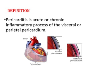 Pericarditis