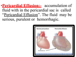 Pericarditis / nursing care | PPTX