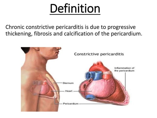 Pericarditis | PPTX | Heart and Cardiovascular Diseases | Diseases and Conditions