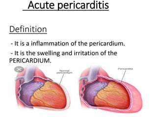 Pericarditis