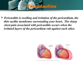 pericarditis-21ydudbbbjgijj0515080610.pptx
