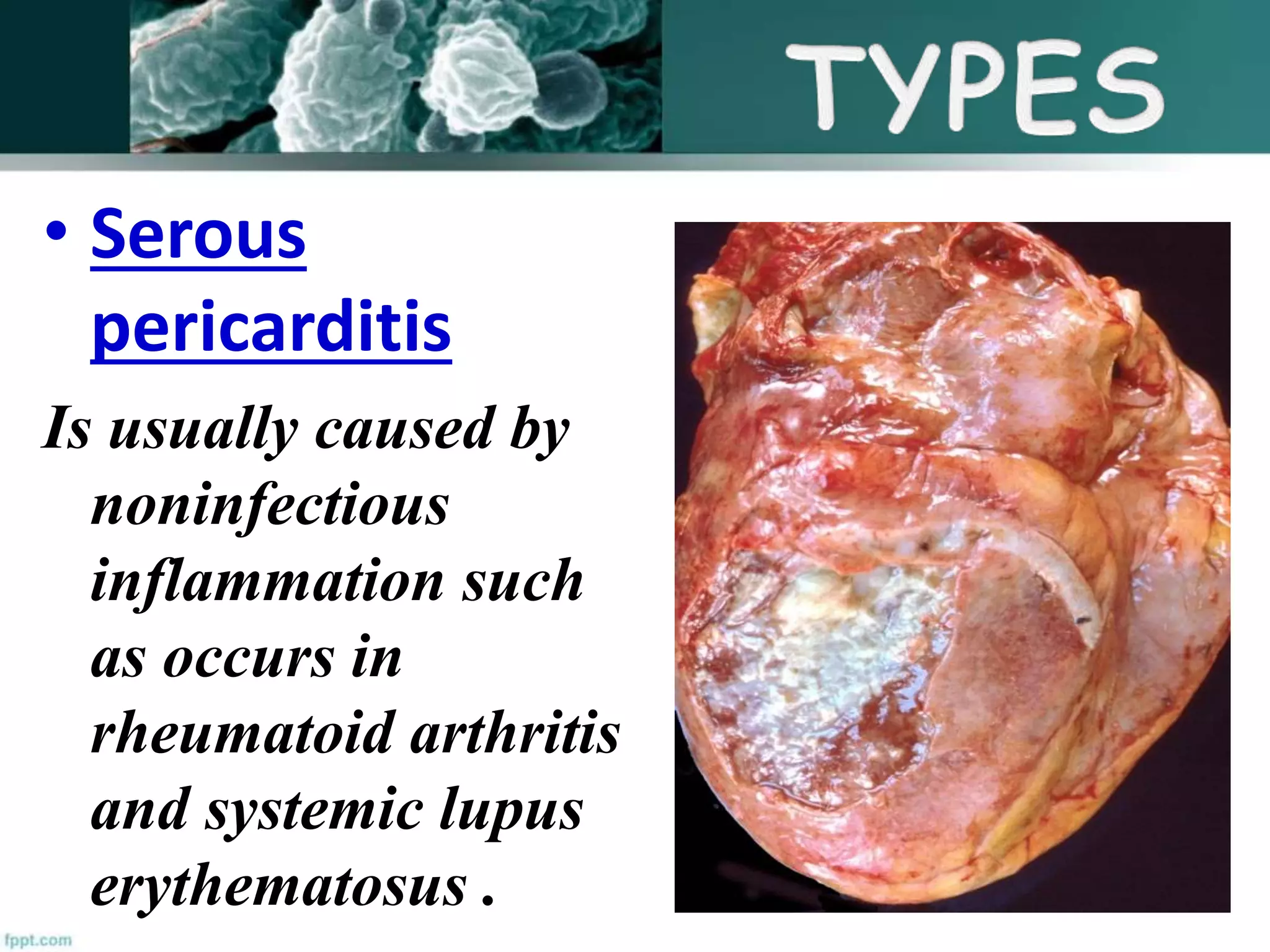 Pericarditis | PPTX
