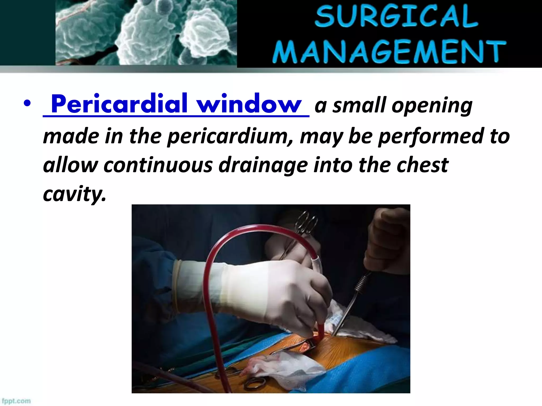 Pericarditis | PPTX