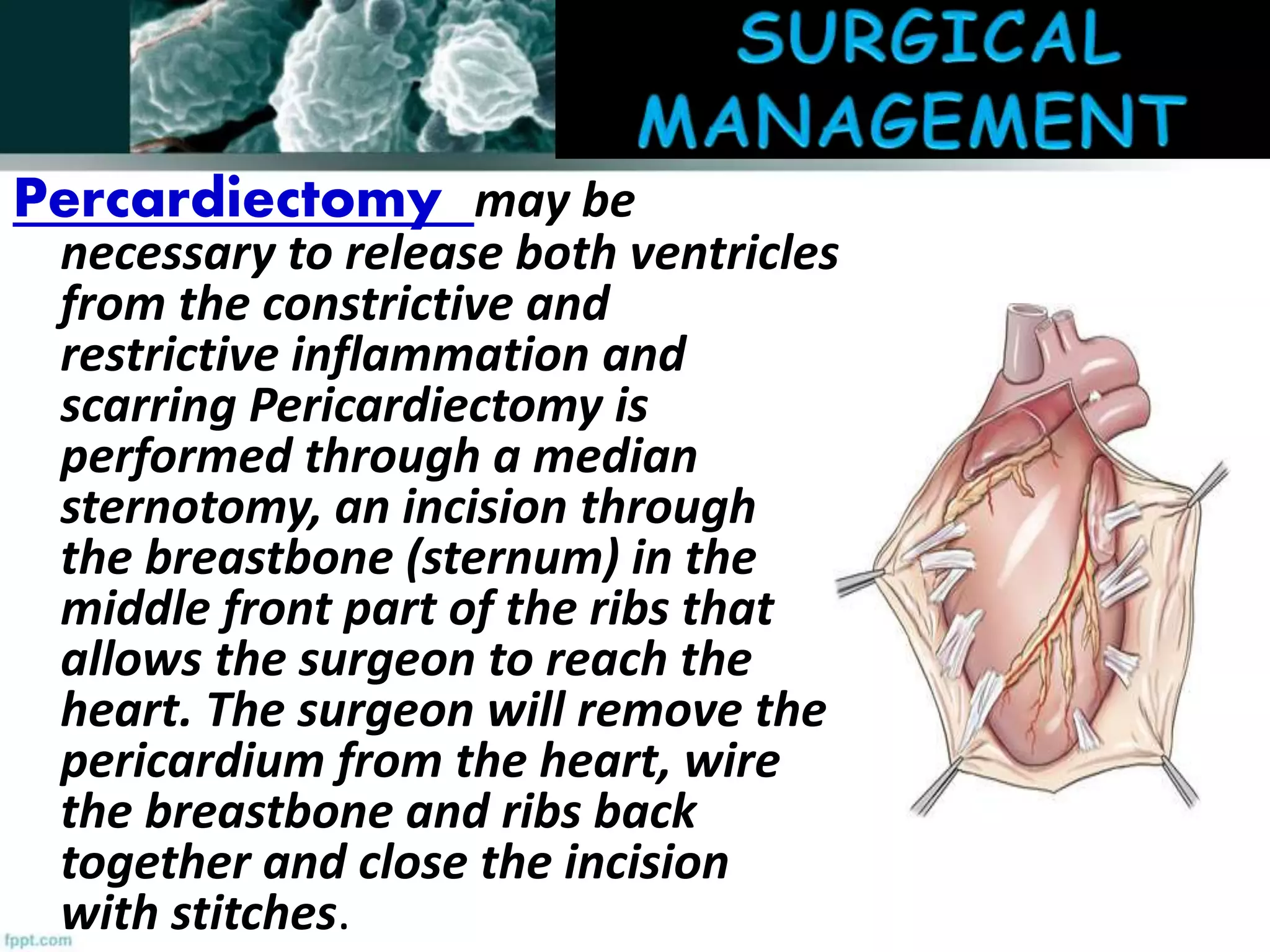 Pericarditis | PPTX