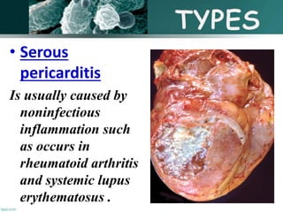 Pericarditis