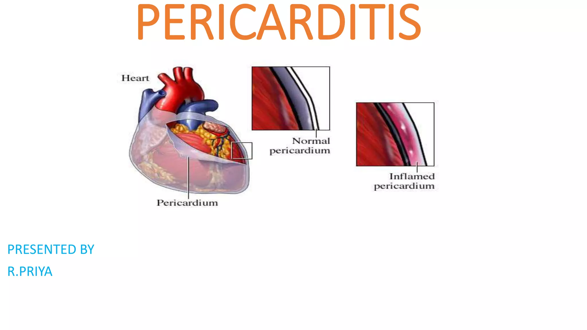 Pericarditis | PPTX