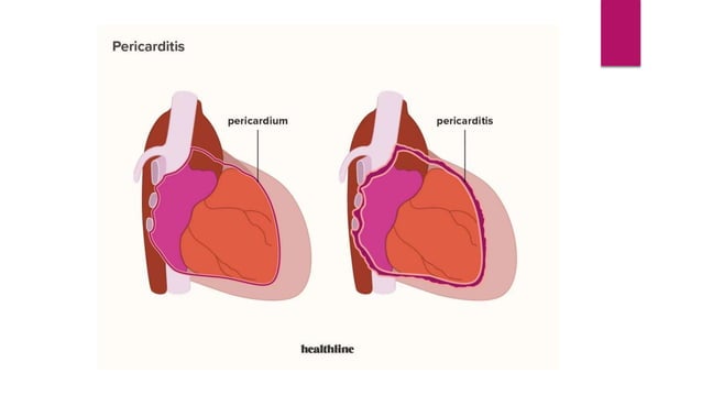 Pericarditis.pptx