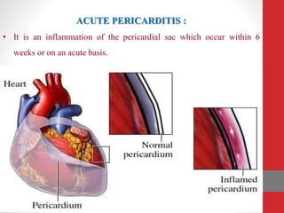 Pericarditis.pptx