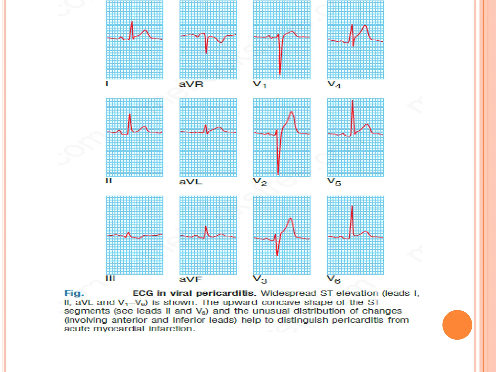 PericarditiS The chest X-ray may show an increase in the size of the ...