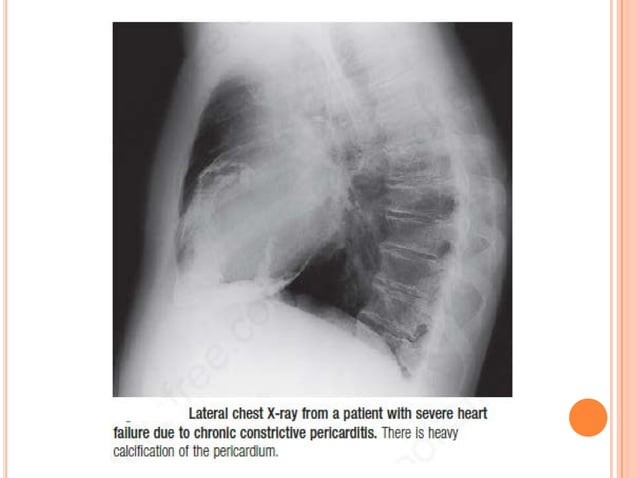 PericarditiS The chest X-ray may show an increase in the size of the ...