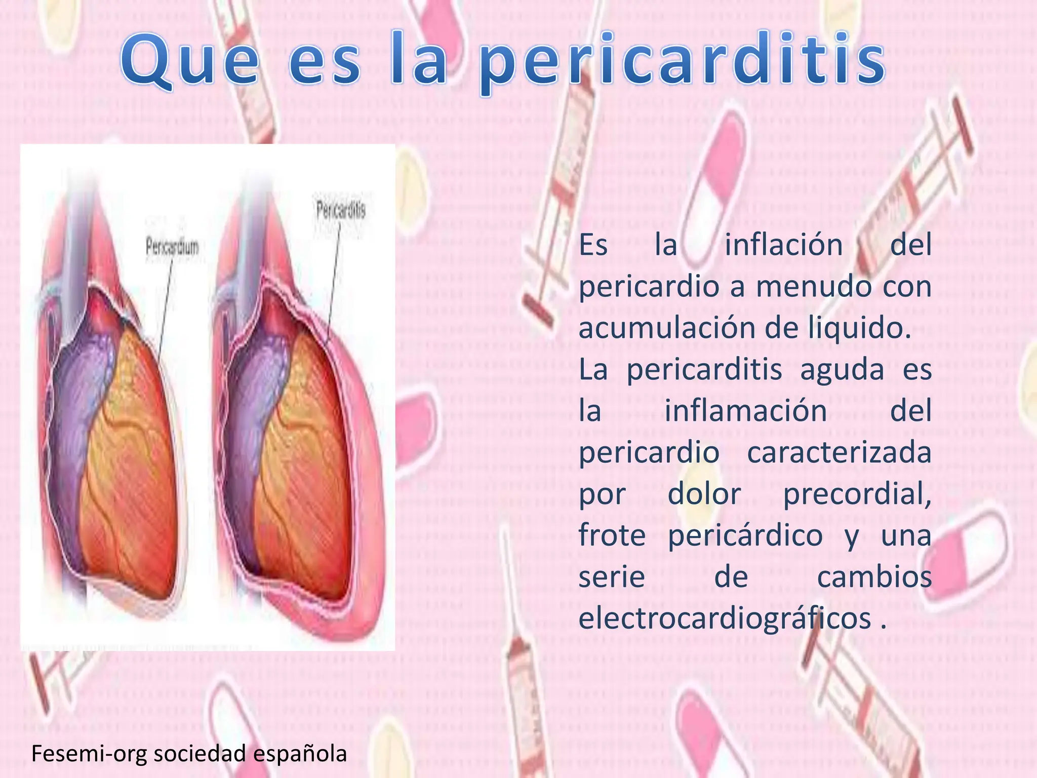 Pericarditis anatomía, fisiopatología, síntomas, tratamiento ...