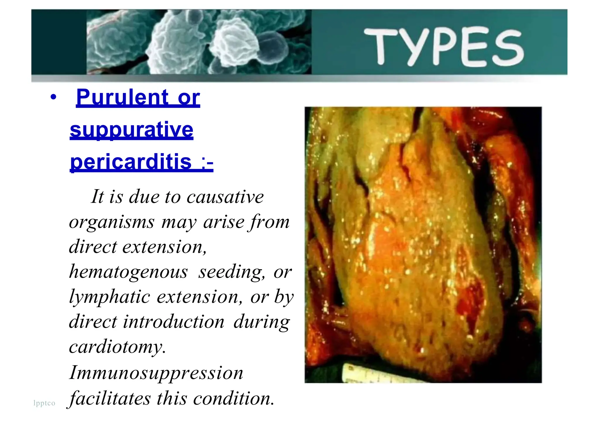 Pericarditis is inflammation of the pericardium (the fibrous sac ...