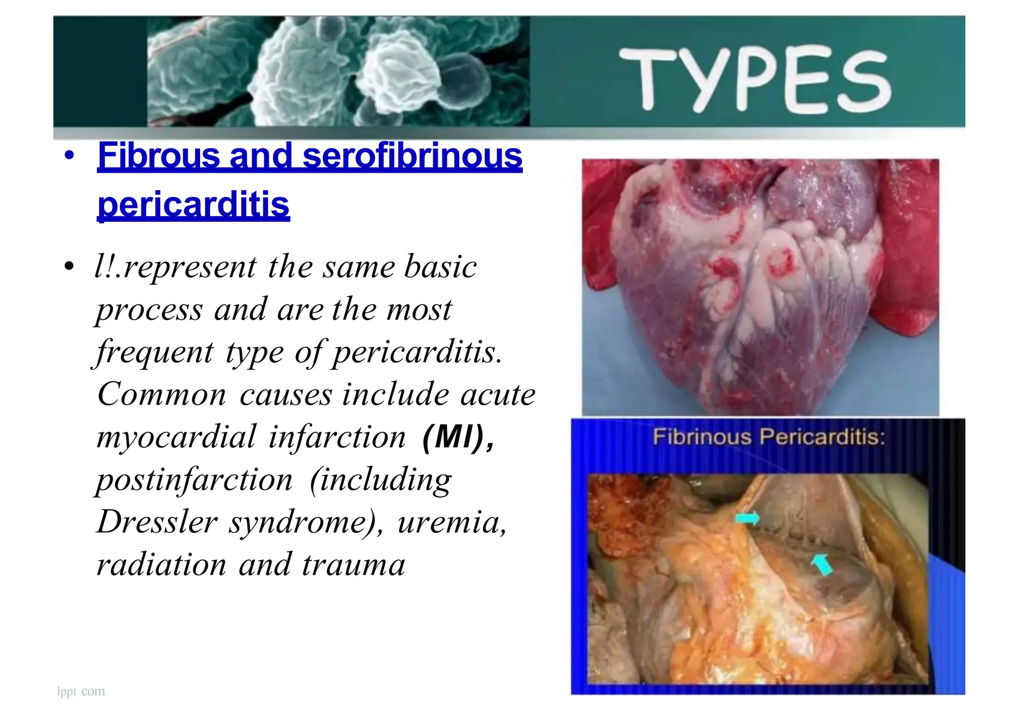 Pericarditis is inflammation of the pericardium (the fibrous sac ...