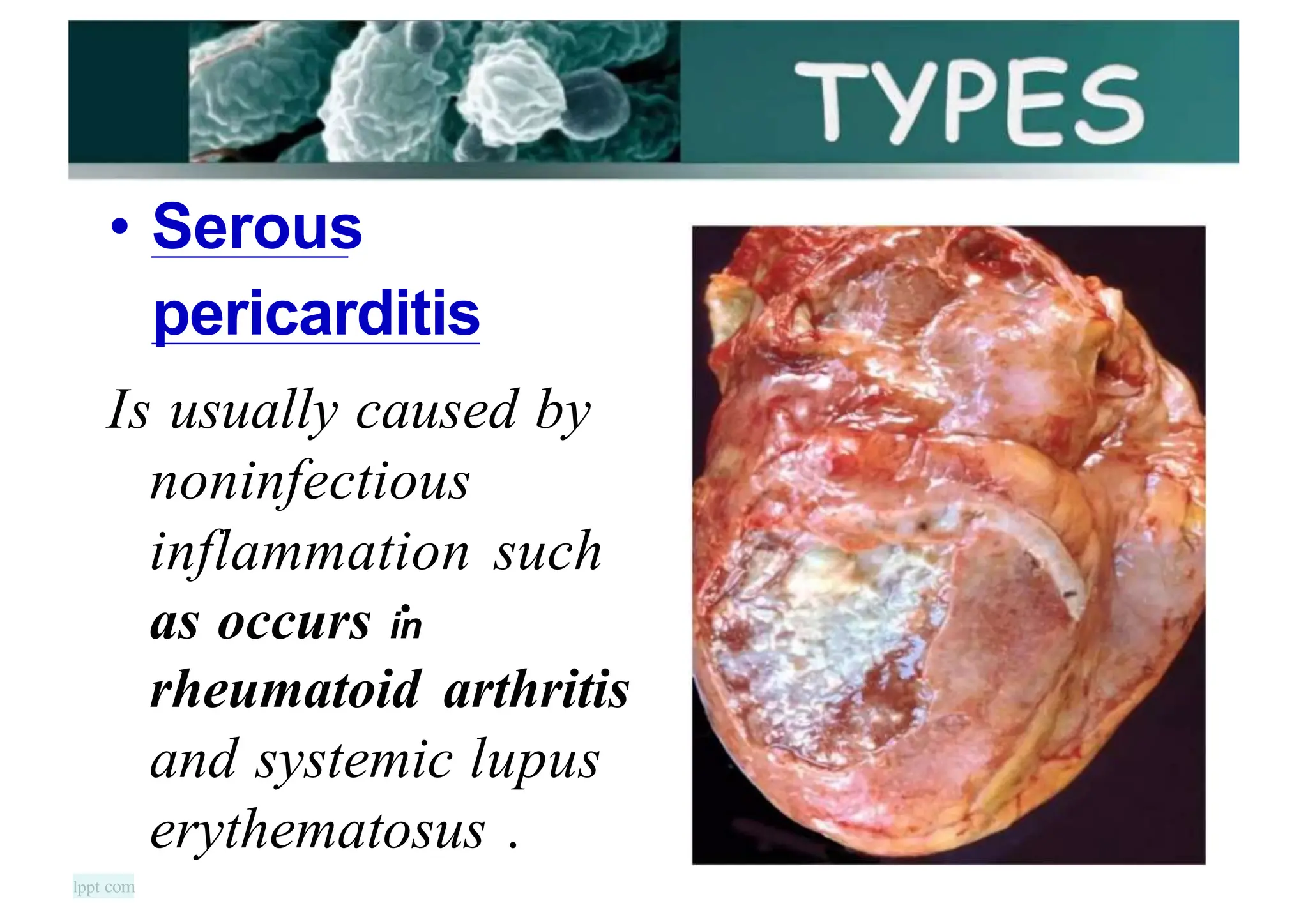 Pericarditis is inflammation of the pericardium (the fibrous sac ...