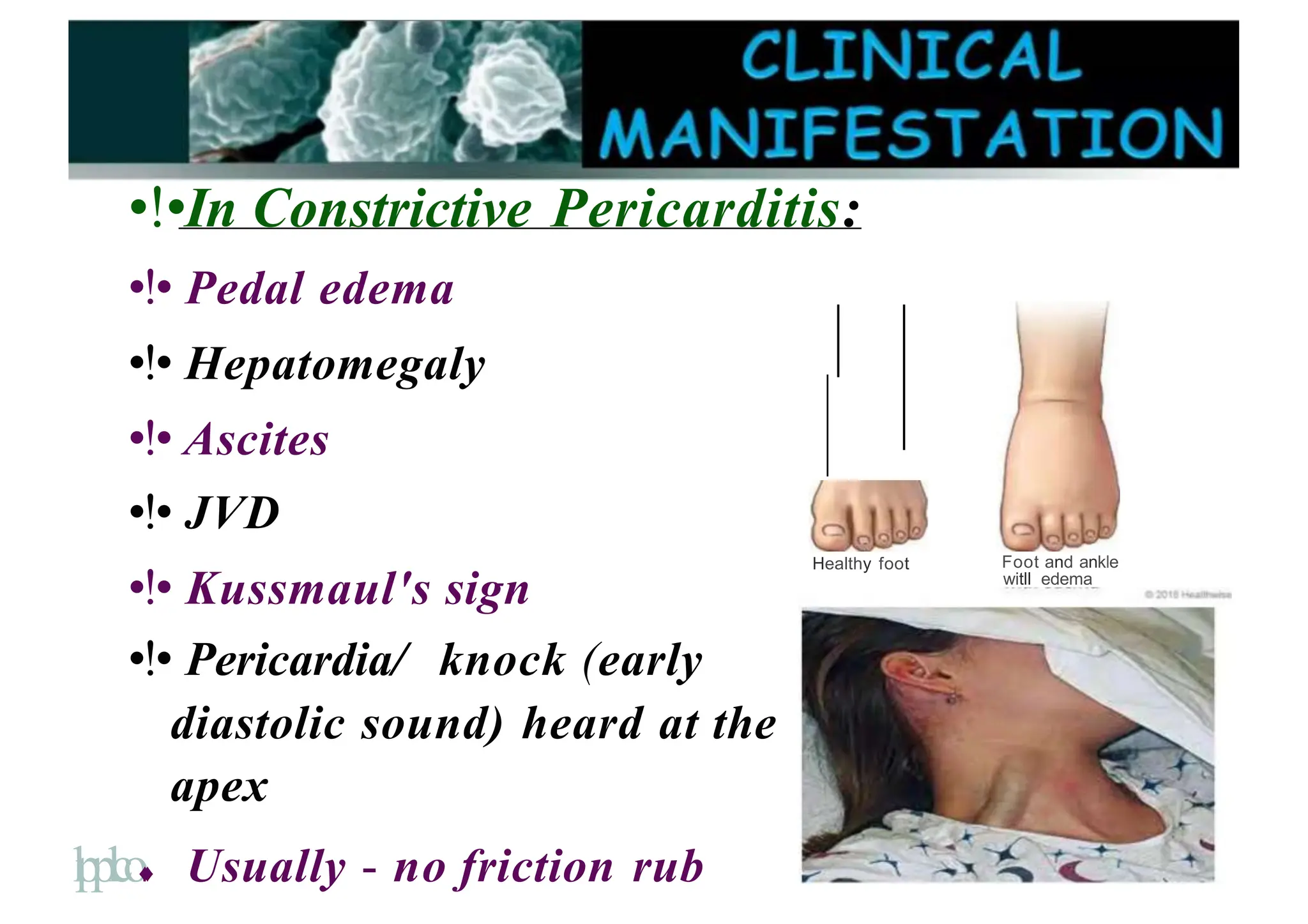 Pericarditis is inflammation of the pericardium (the fibrous sac ...