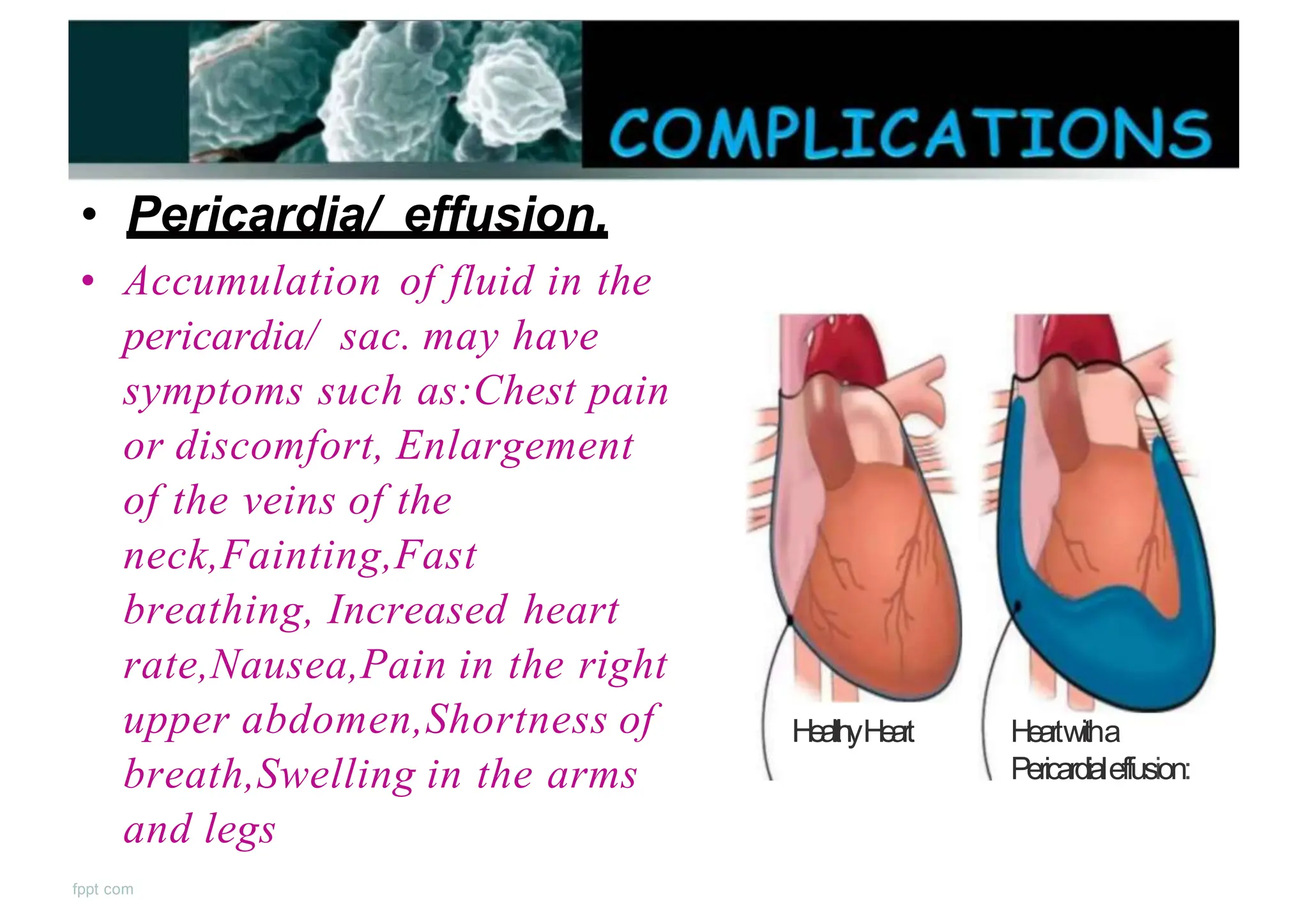 Pericarditis is inflammation of the pericardium (the fibrous sac ...