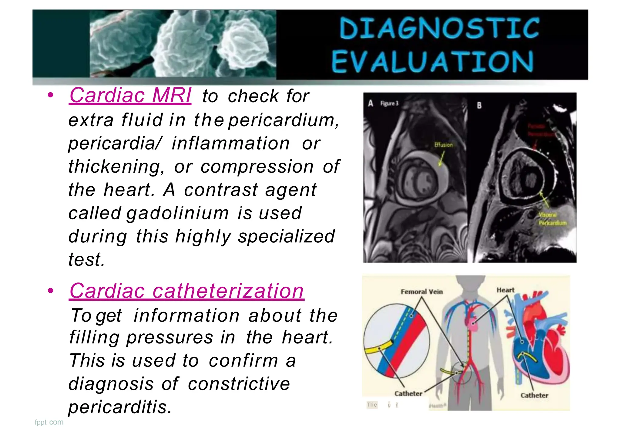 Pericarditis is inflammation of the pericardium (the fibrous sac ...