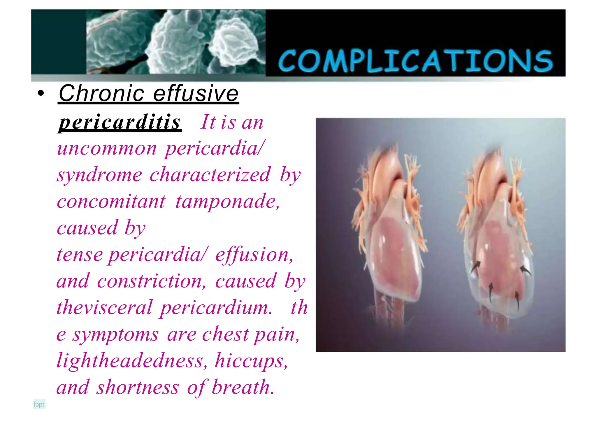 Pericarditis is inflammation of the pericardium (the fibrous sac ...