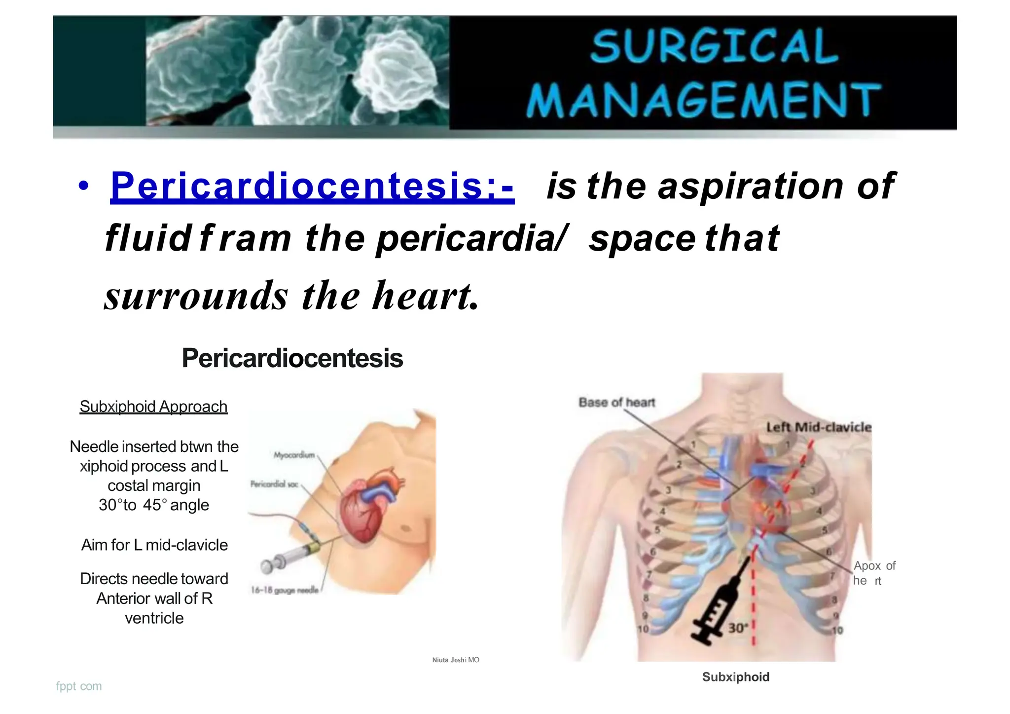 Pericarditis is inflammation of the pericardium (the fibrous sac ...