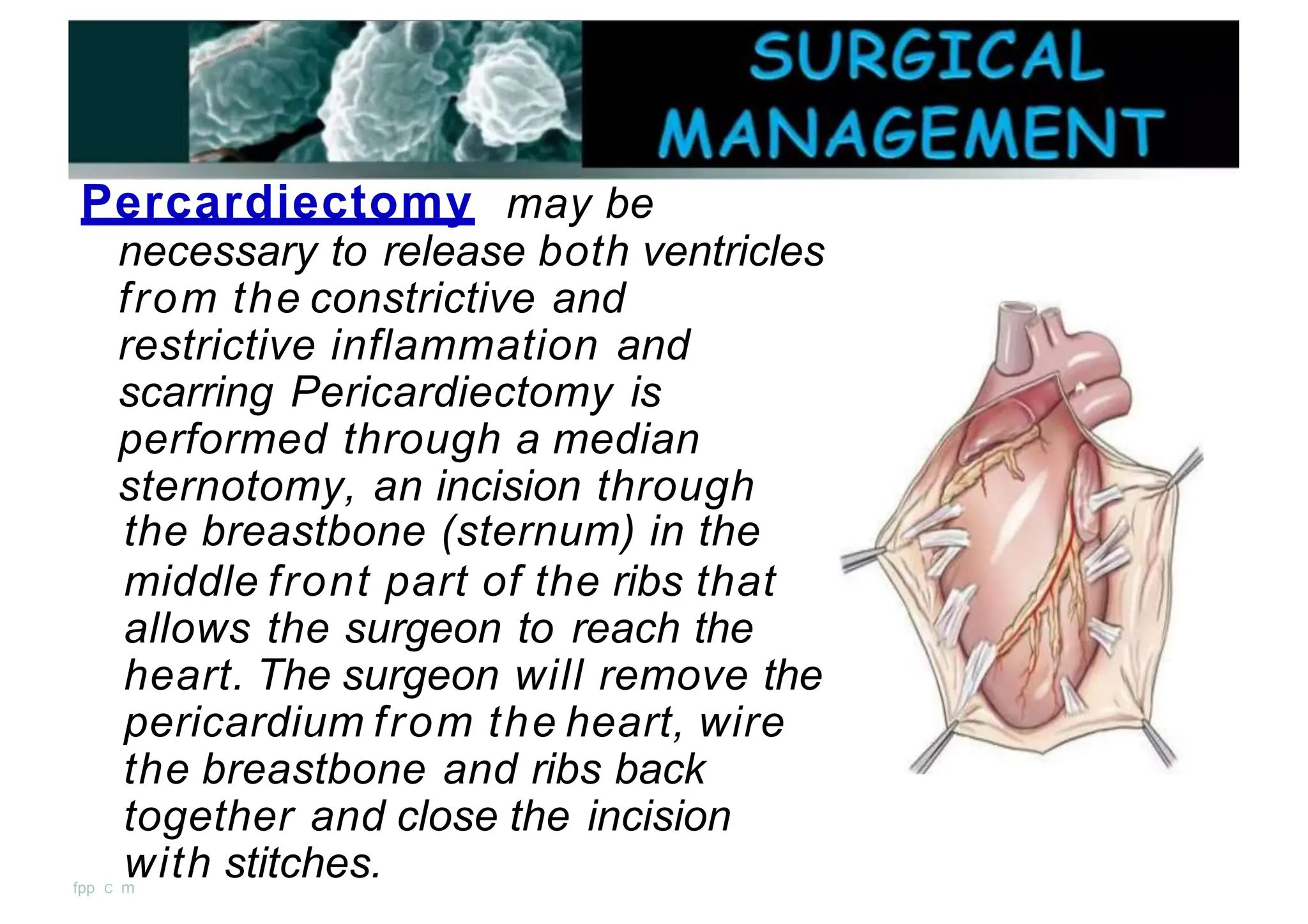 Pericarditis is inflammation of the pericardium (the fibrous sac ...