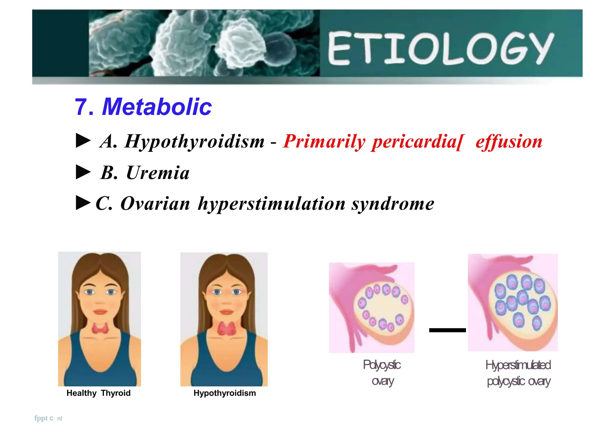Pericarditis is inflammation of the pericardium (the fibrous sac ...