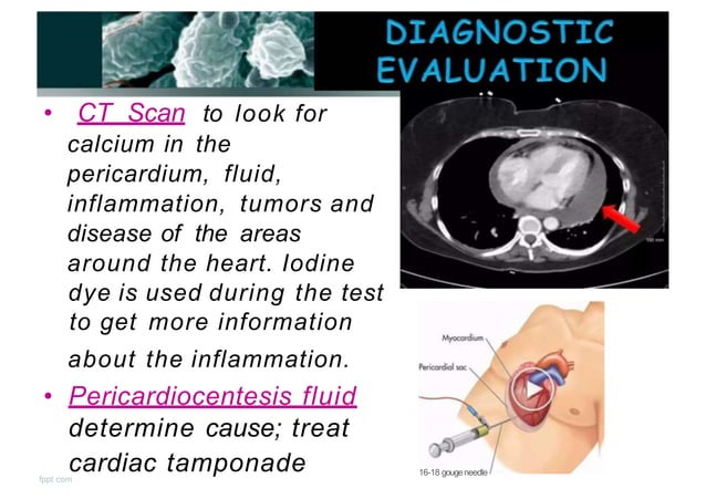 Pericarditis is inflammation of the pericardium (the fibrous sac ...