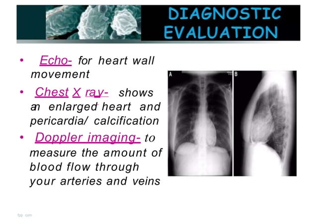 Pericarditis is inflammation of the pericardium (the fibrous sac ...