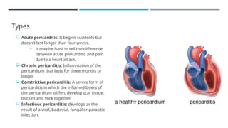 Identify the symptoms and clinical manifestations of Pericarditis | PPTX