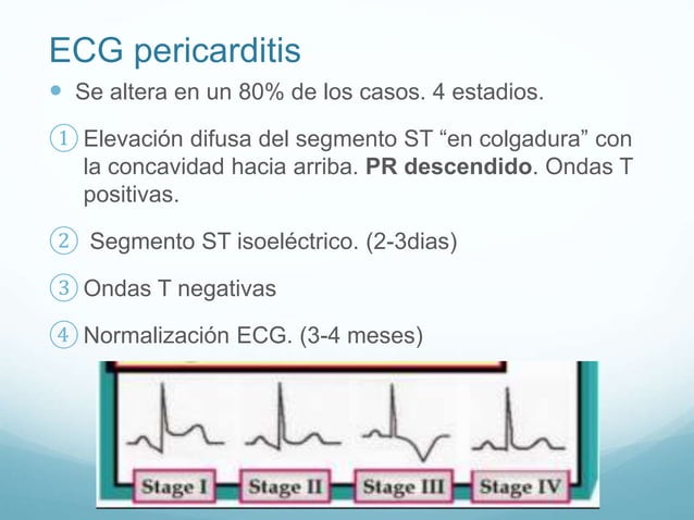 Pericarditis aguda | PPTX