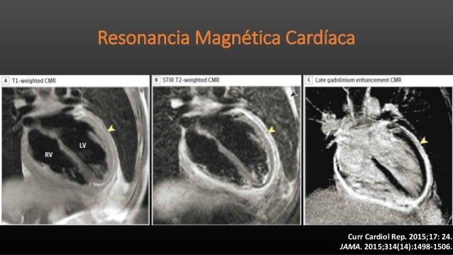 Pericarditis Aguda