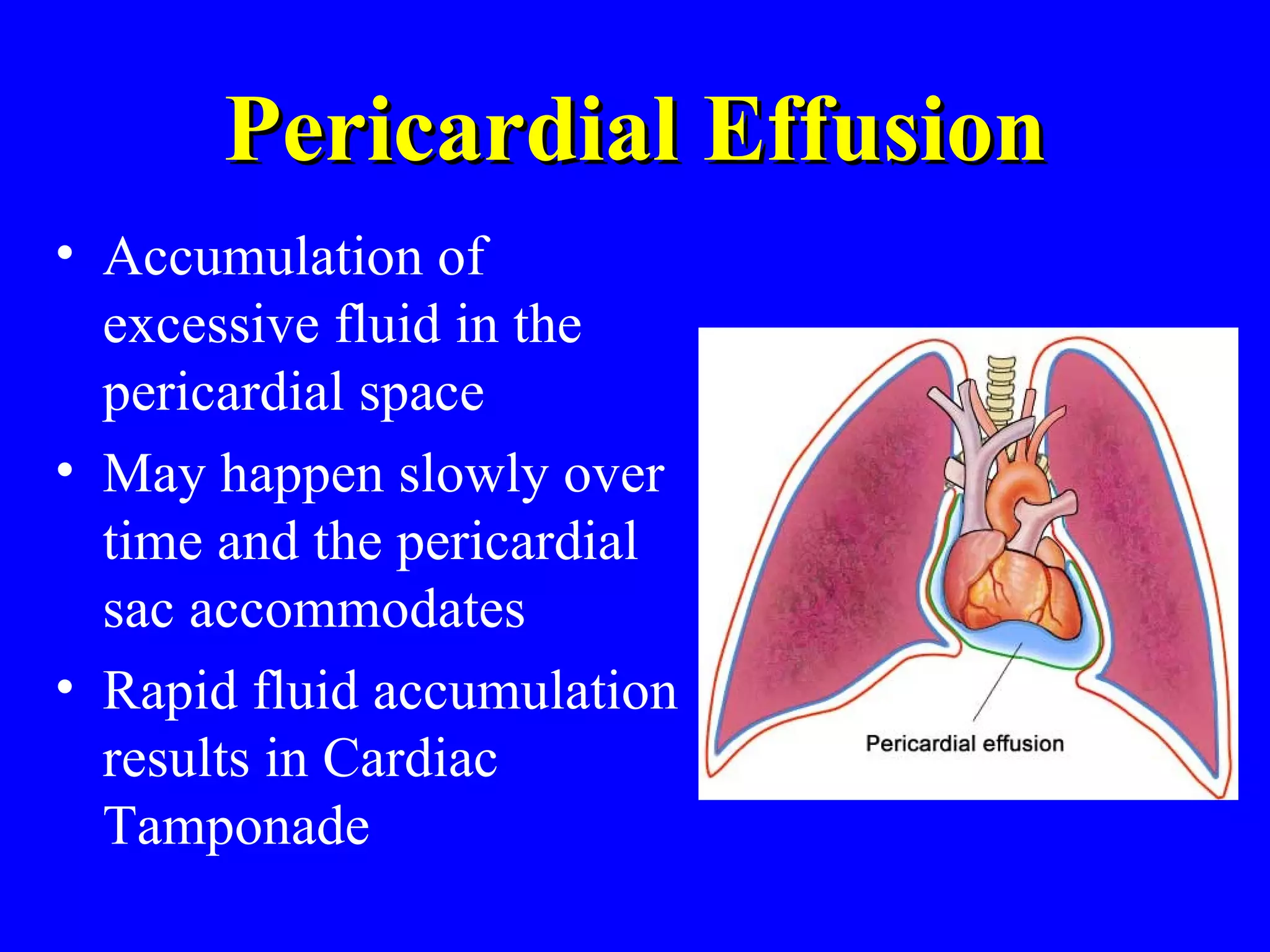 Pericarditis, Pericardial Effusion, & Cardiac Tamponade - BMH/Tele | PPT