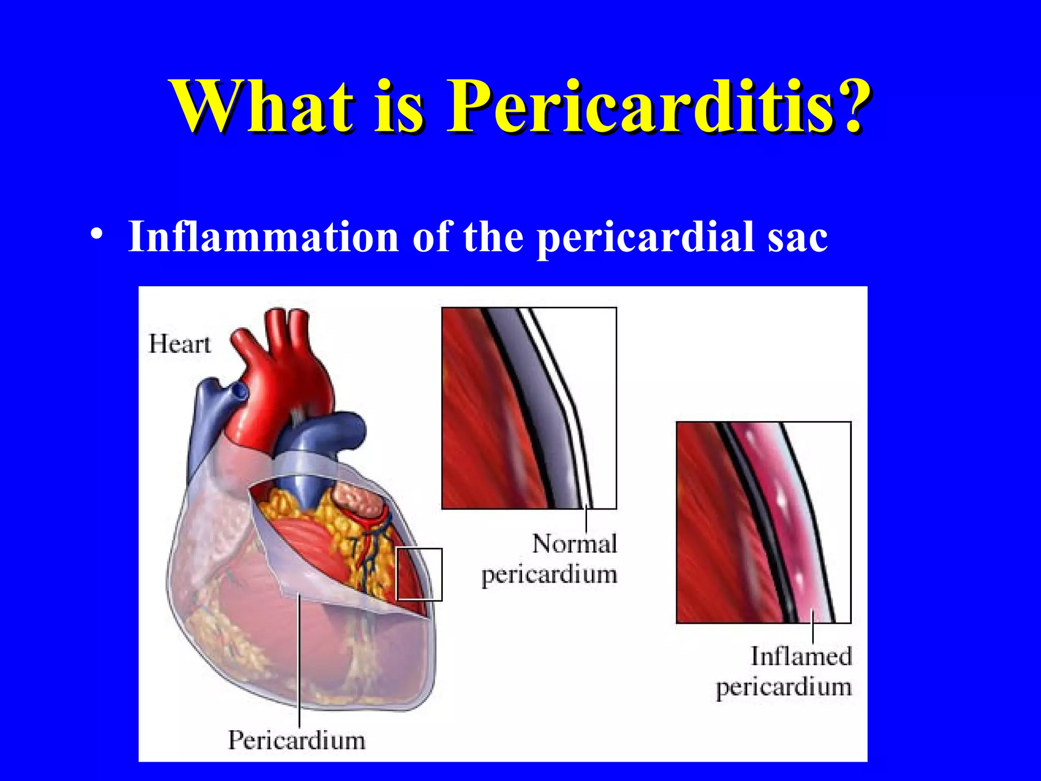 Pericarditis, Pericardial Effusion, & Cardiac Tamponade - BMH/Tele | PPT