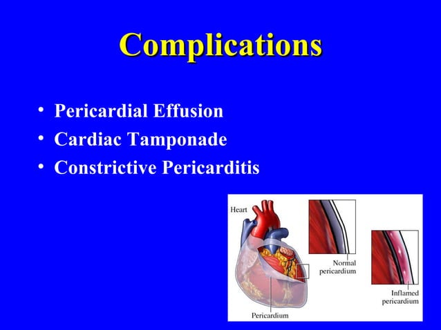 Pericarditis, Pericardial Effusion, & Cardiac Tamponade - BMH/Tele | PPT