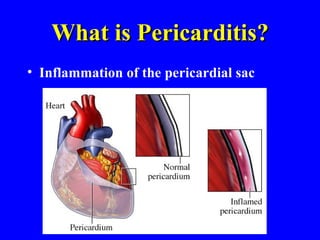 Pericarditis, Pericardial Effusion, & Cardiac Tamponade - BMH/Tele | PPT
