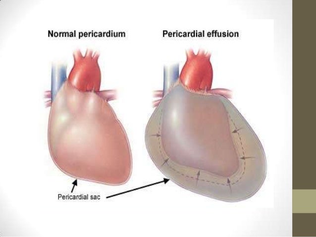 Pericarditis crónica