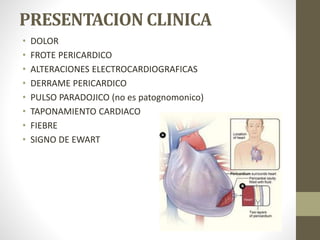 Pericarditis expo | PPT