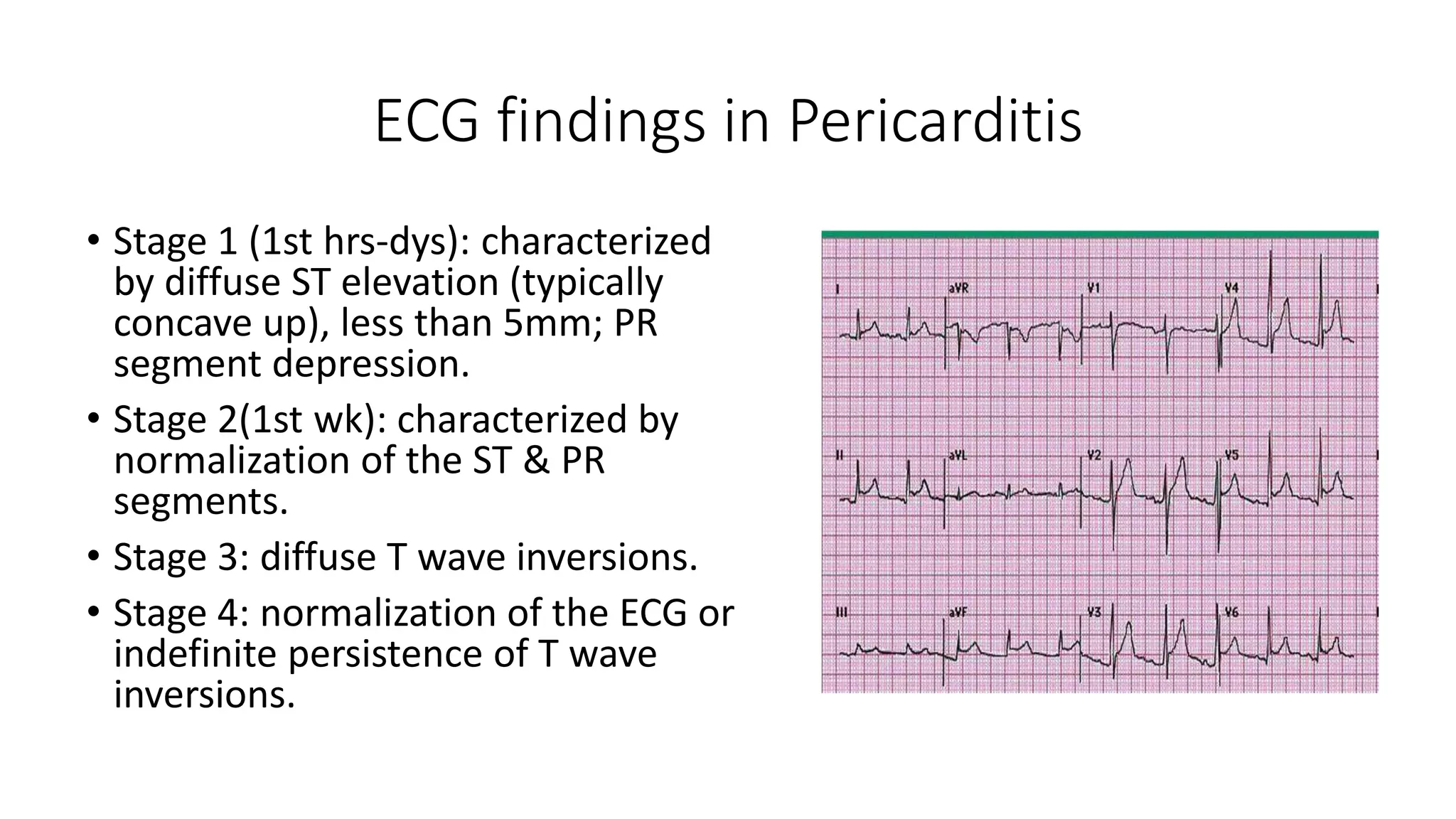 Pericarditis for student | PDF