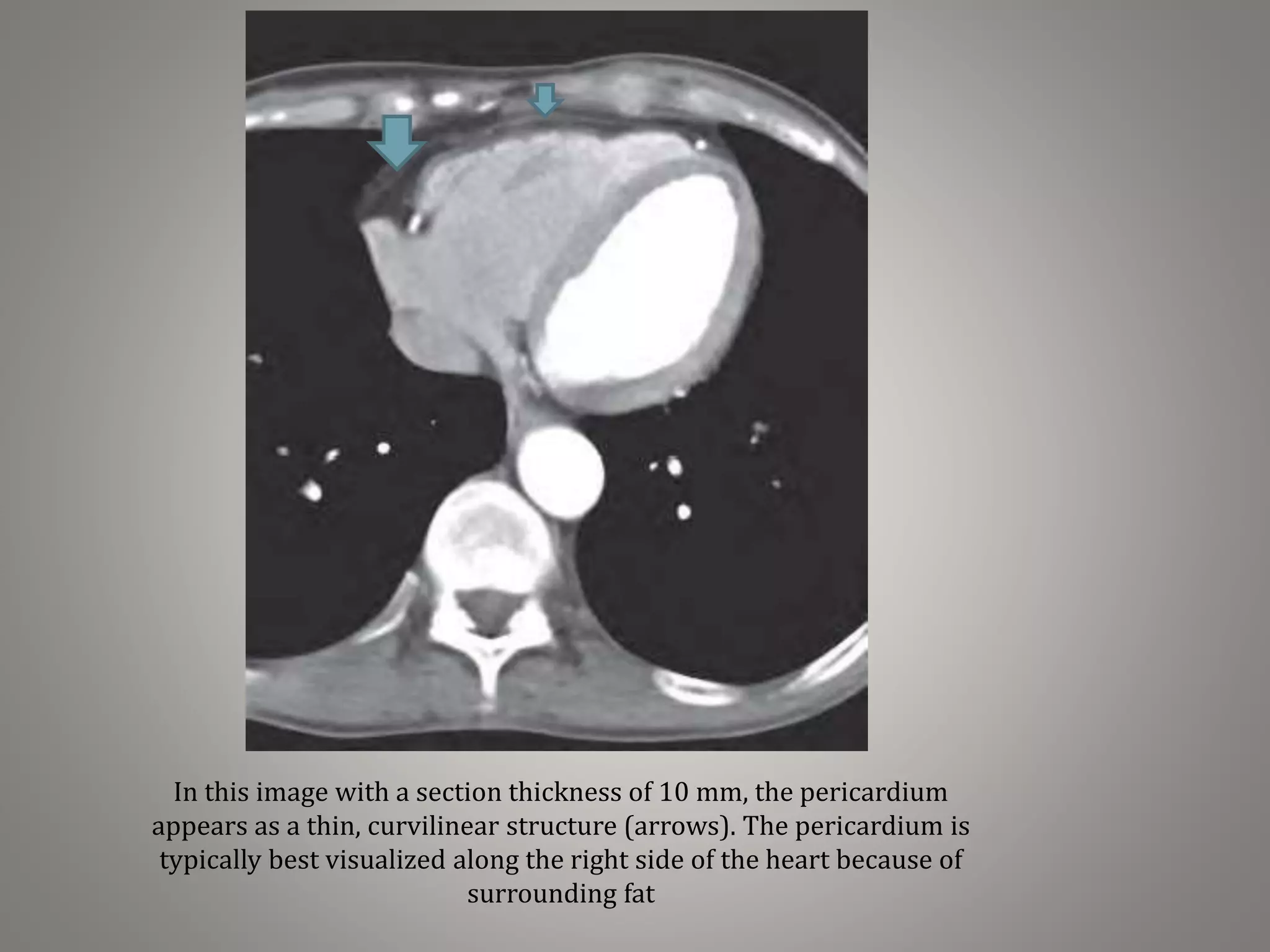 pericardium.pptx