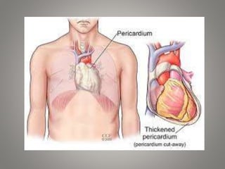 pericardium.pptx