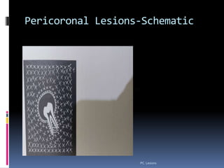 Pericoranal lesions.pptx