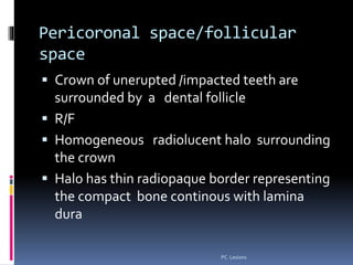 Pericoranal lesions.pptx