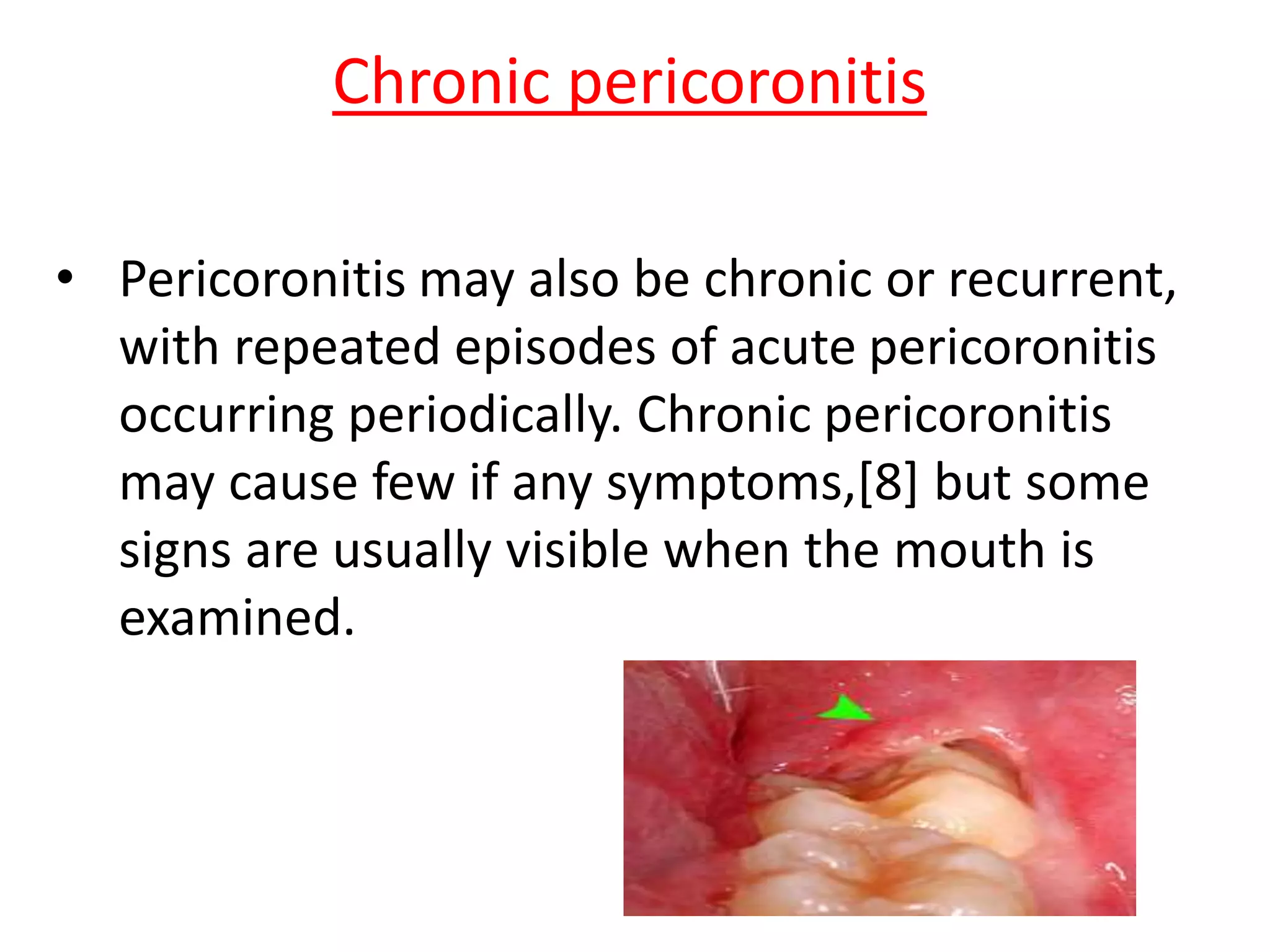 Pericoronitis | PPTX