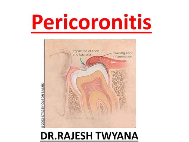 Pericoronitis | PPTX | Ear, Nose and Throat Conditions | Diseases and ...