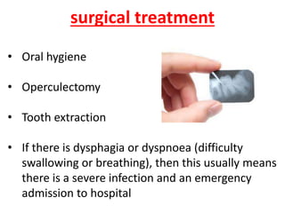 Pericoronitis | PPTX