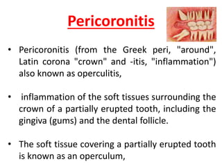 Pericoronitis | PPTX