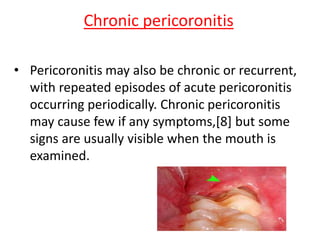 Pericoronitis | PPTX