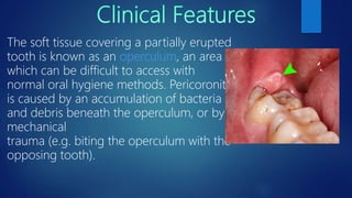 Pericoronitis | PPTX